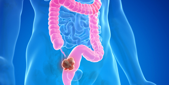 manejo clinico - TRATAMIENTO MULTIDISCIPLINARIO DEL CÁNCER